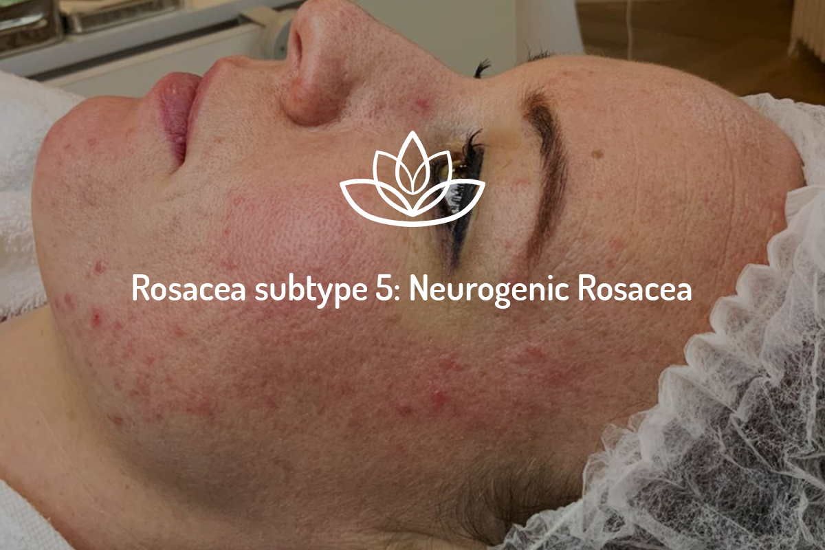 Rosacea subtype 5: Neurogenic rosacea - Rositta Kliniek